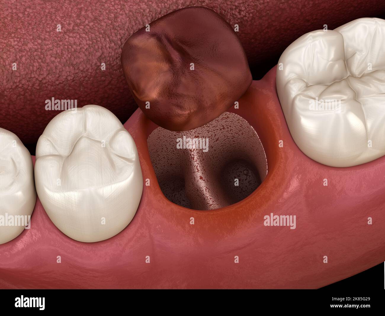 Alveolits - opened dry soket after tooth extraction. Medically accurate ...