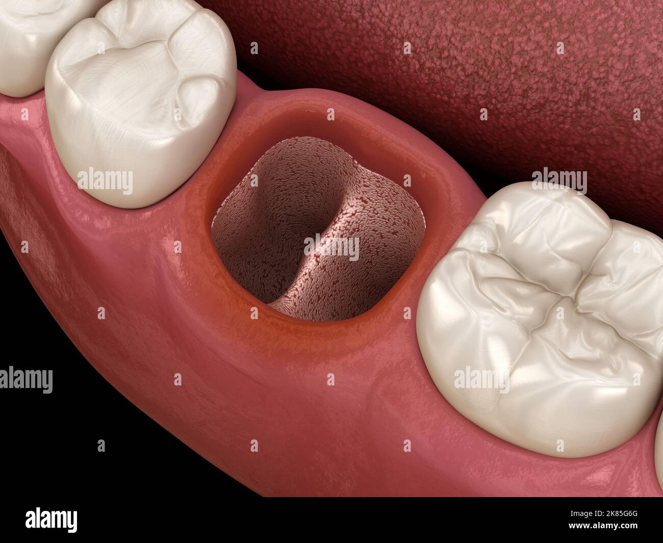 Alveolits - opened dry soket after tooth extraction. Medically accurate ...