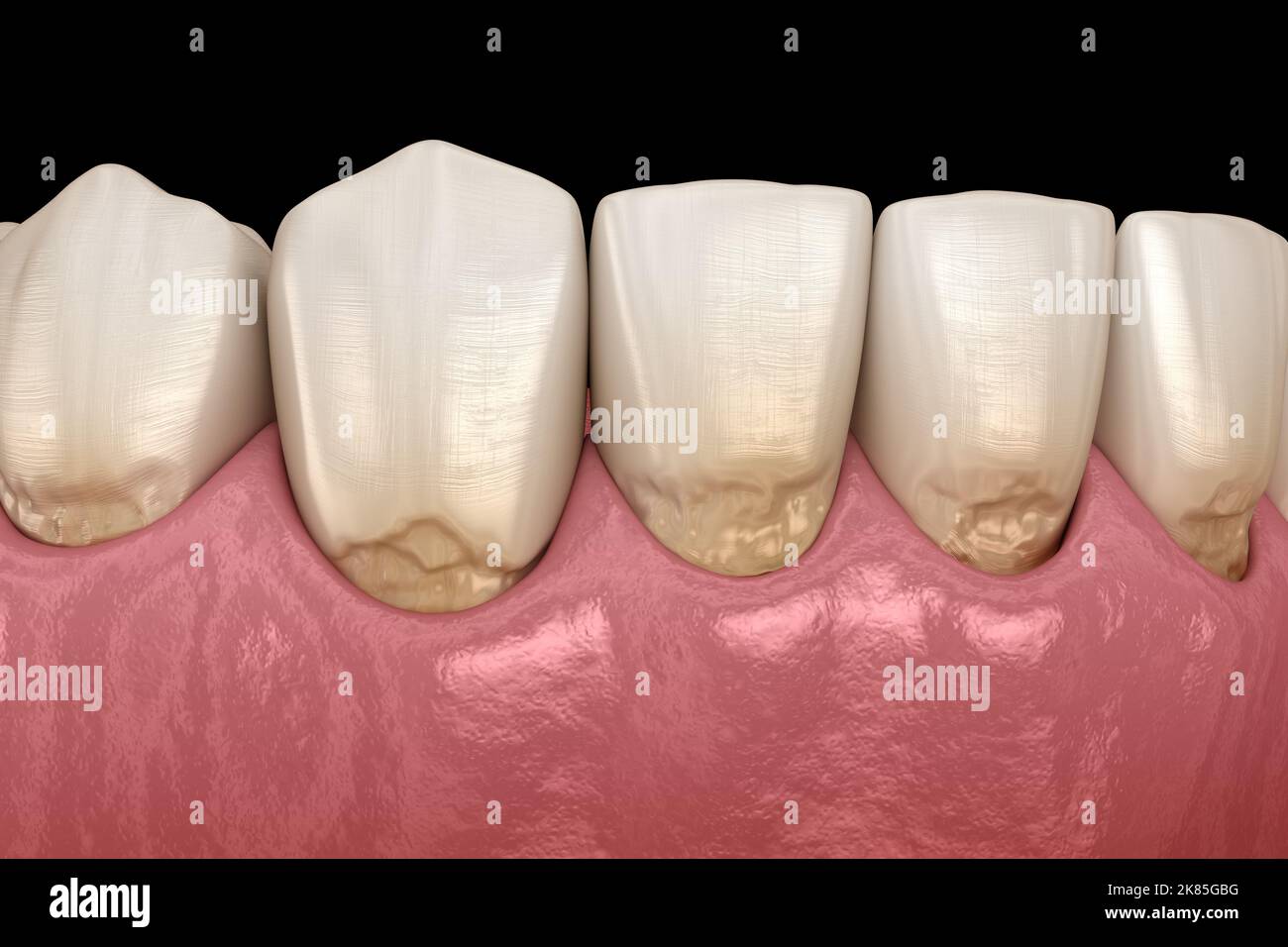 Abfraction of anterior teeth. Medically accurate 3D illustration Stock ...