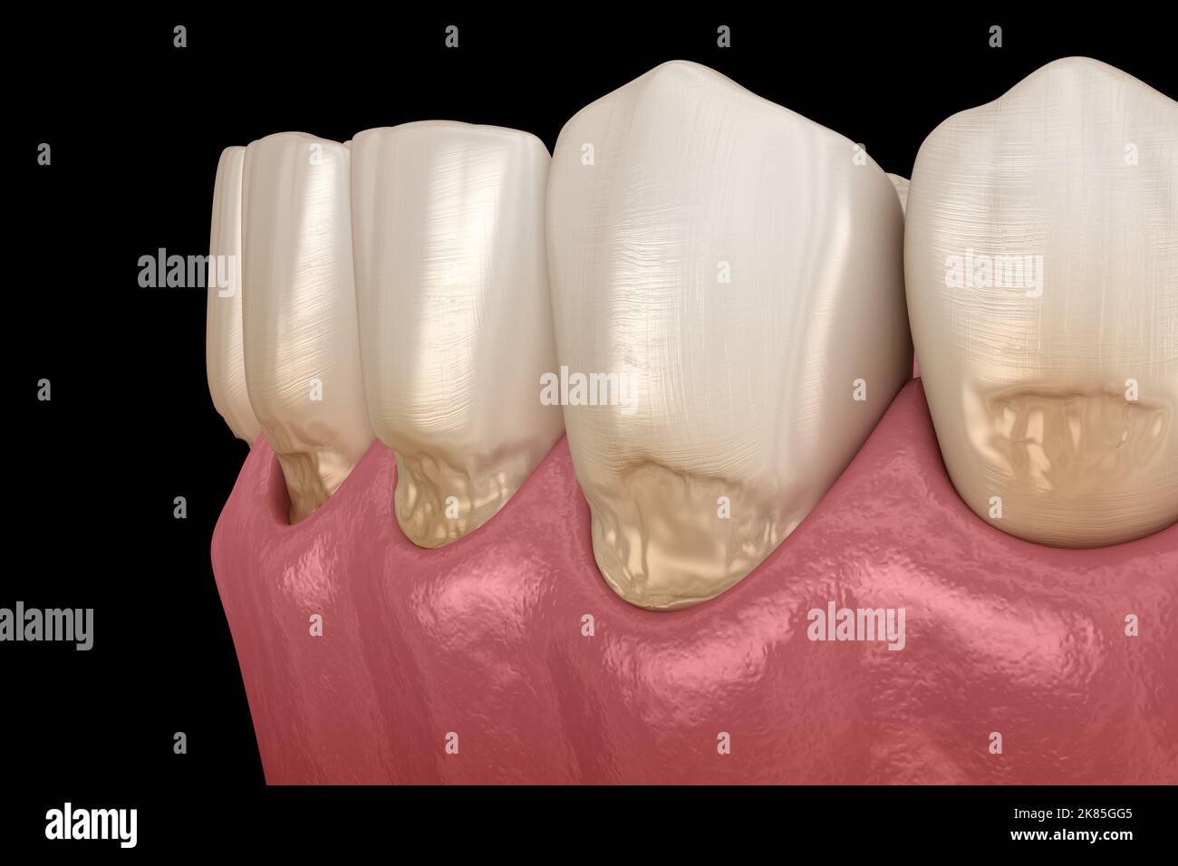 Abfraction of anterior teeth. Medically accurate 3D illustration Stock ...