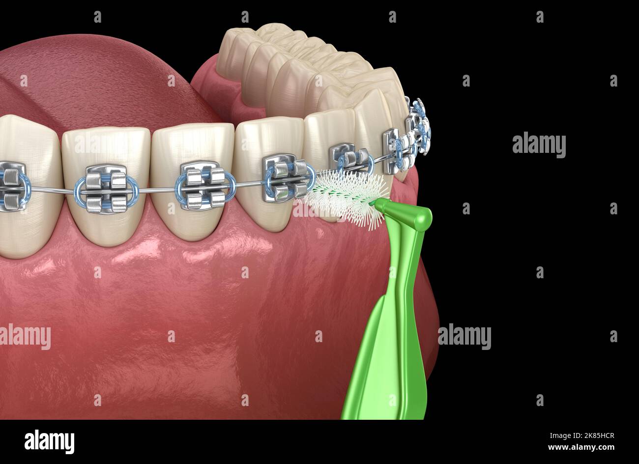 Interdental tooth brush and braces cleaning. Medically accurate 3D ...