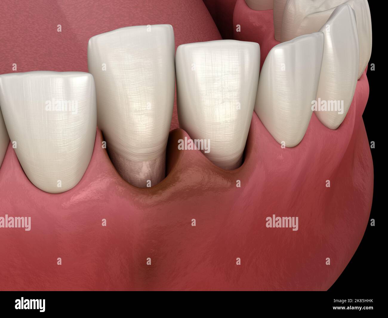 Tooth dislocation after trauma. Medically accurate 3D illustration ...