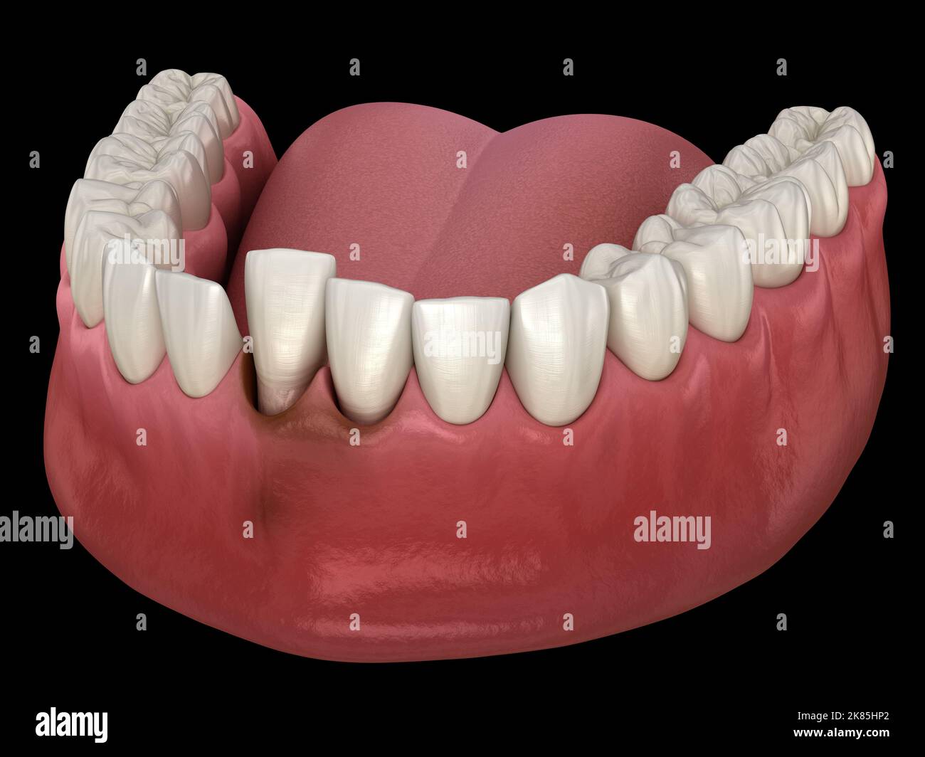 Tooth dislocation after trauma. Medically accurate 3D illustration ...
