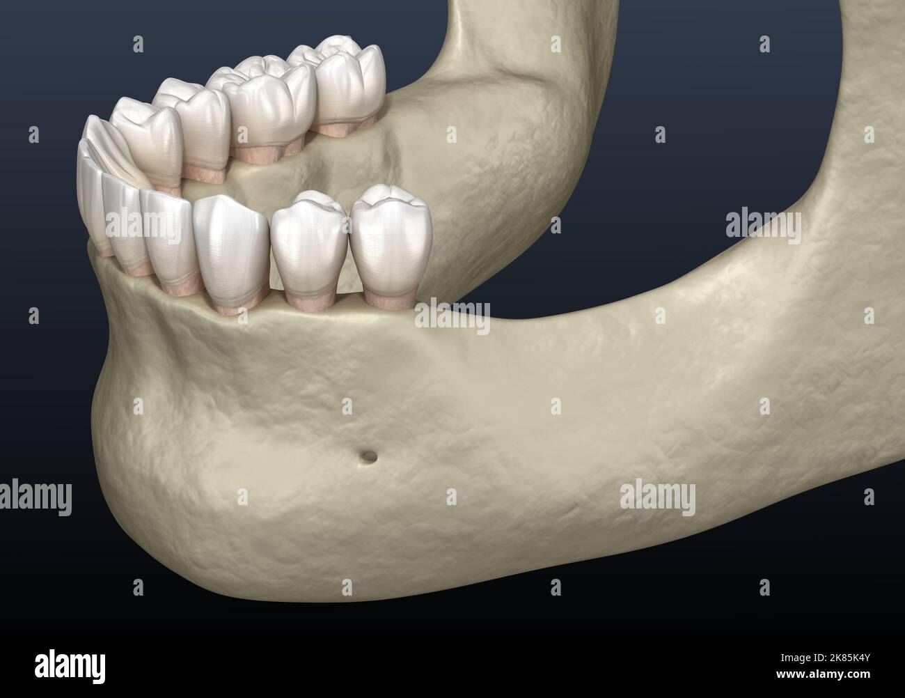 Mandibular Jaw, bone recession after losing molars teeth. Medically ...