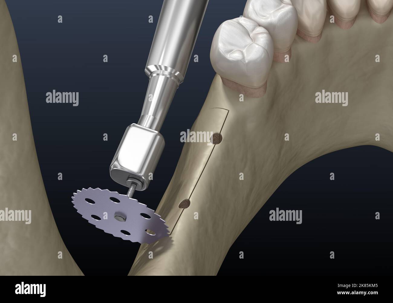 Cleavage of the alveolar ridge, augmentation. Dental surgery, 3D ...