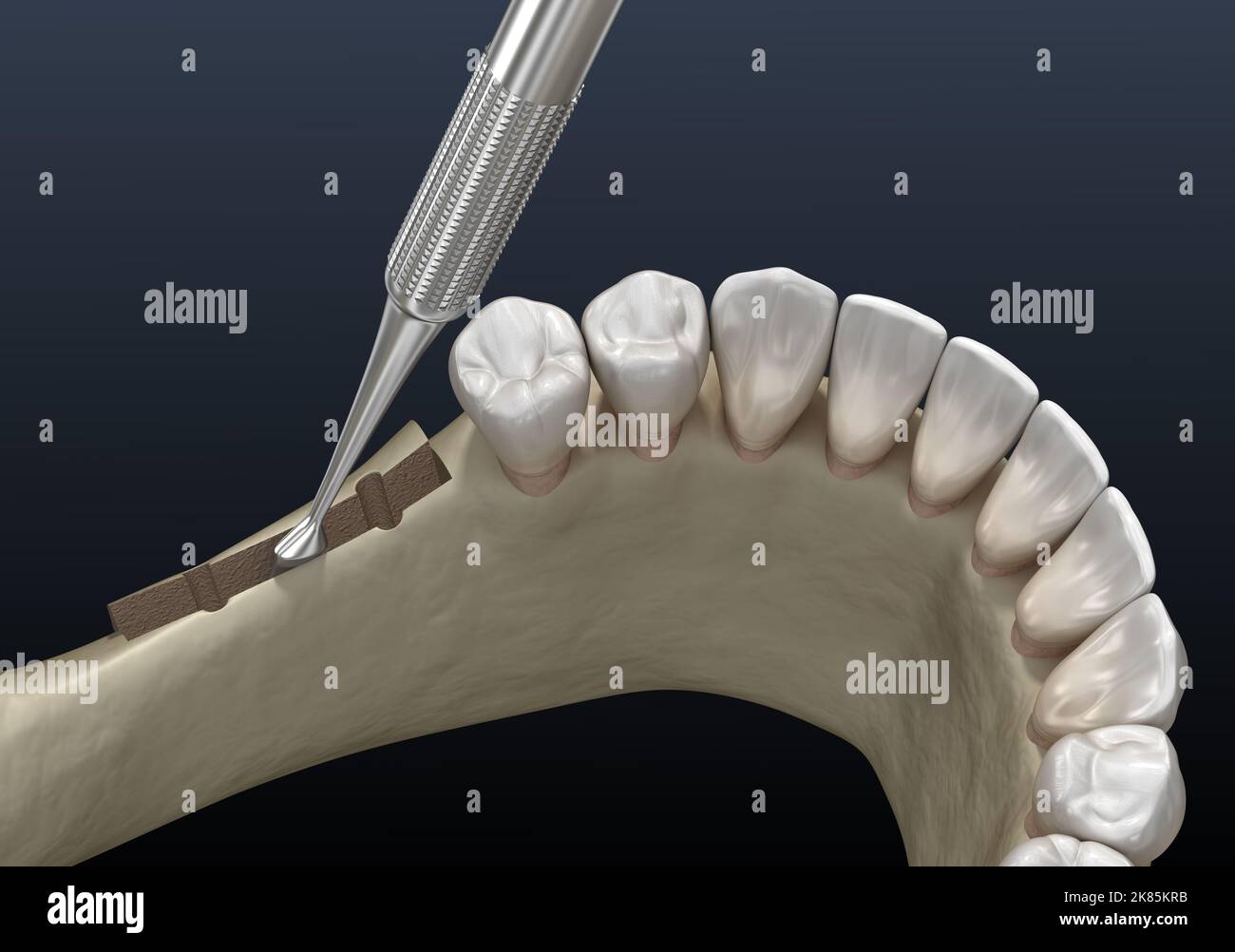 Ridge augmentation hi-res stock photography and images - Alamy