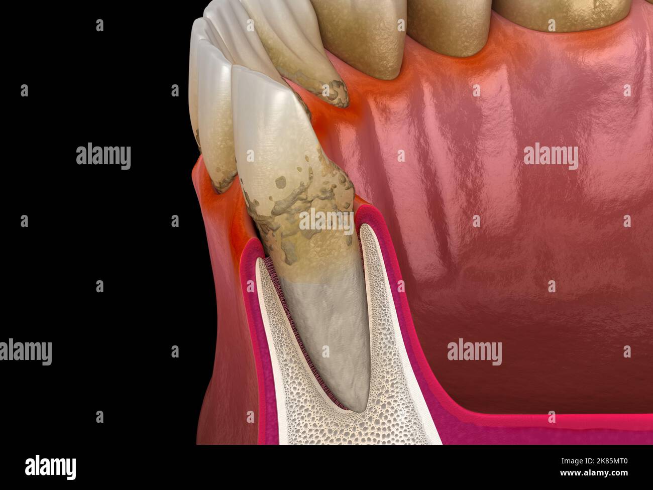 Periodontitis stage 2, gum recession, tartar. Medically accurate 3D ...