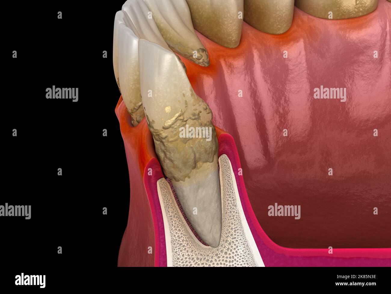 Periodontitis stage 3, gum recession, tartar. Medically accurate 3D ...