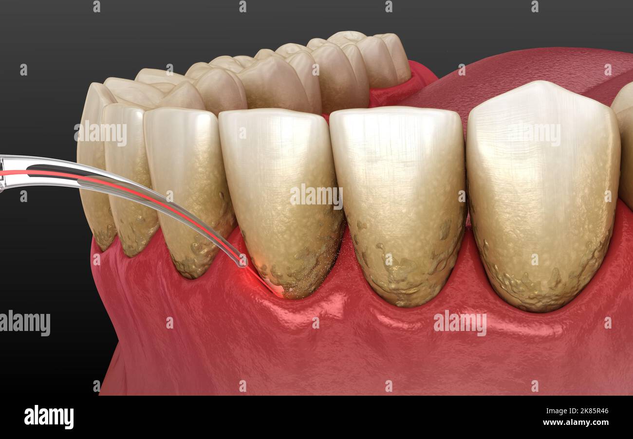 Laser removes tartar and thin layer of infected skin, teeth cleaning ...
