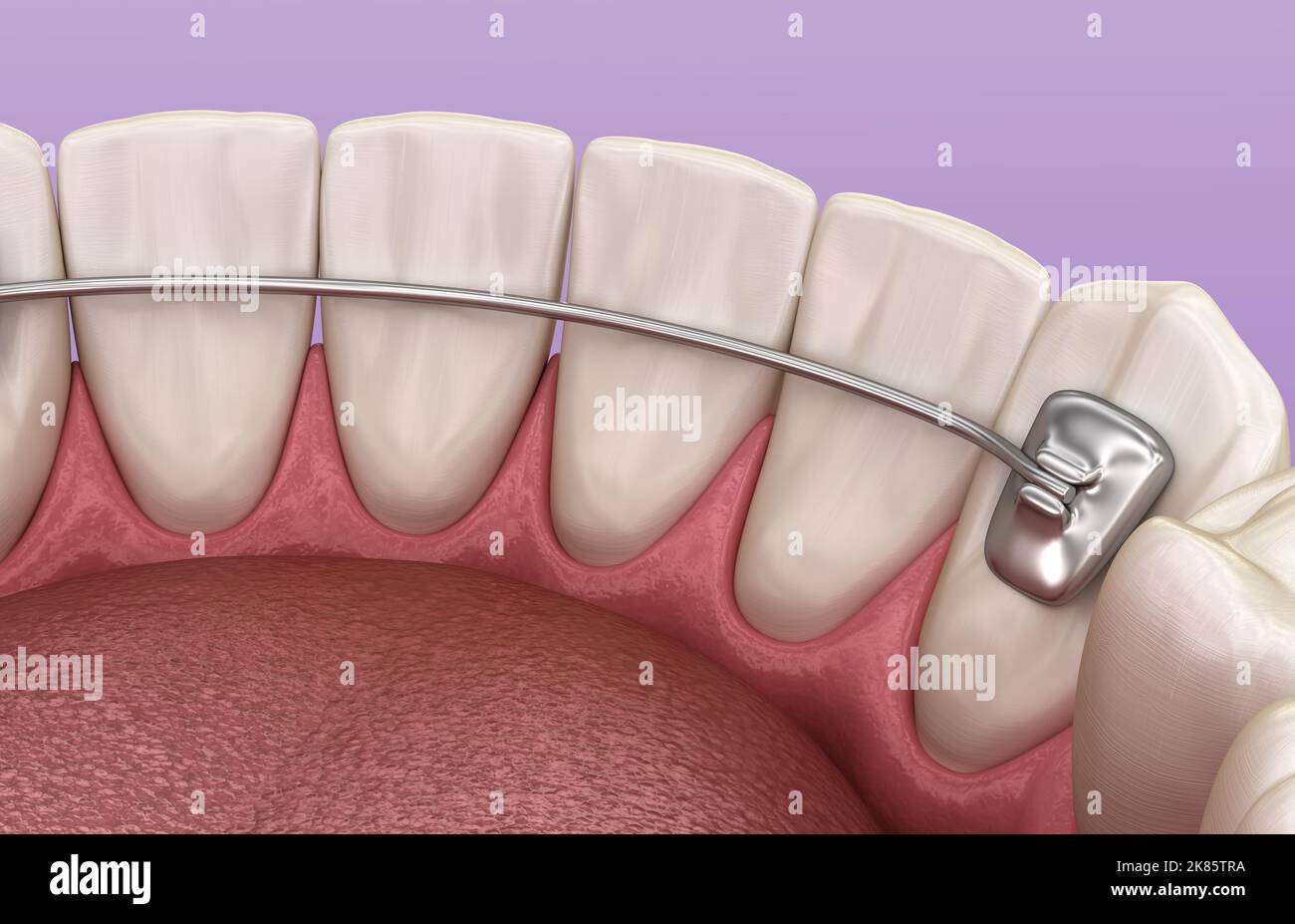Retainers dental installed after braces treatment, Medically accurate ...