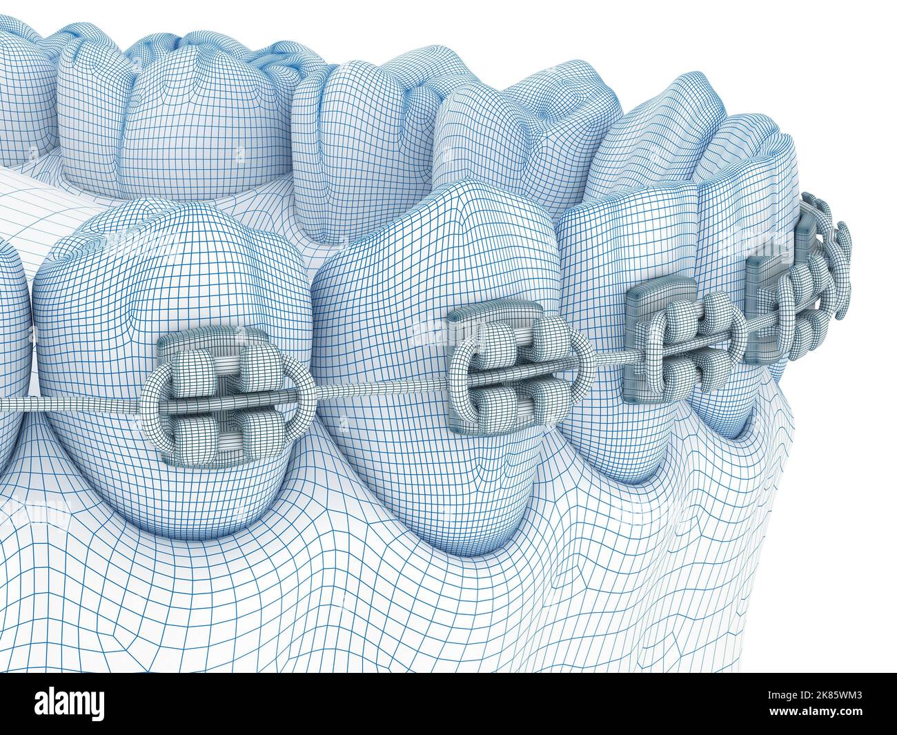 Braces and denture. Wire 3d model illustration Stock Photo - Alamy