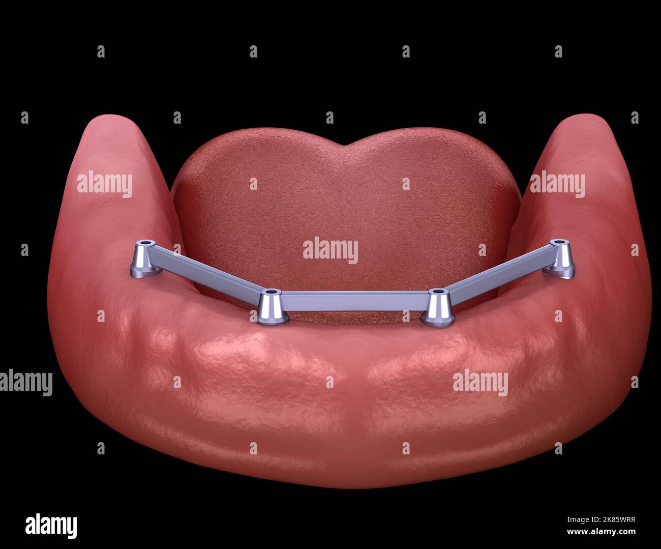 Removable Mandibular prosthesis with gum All on 4 system supported by ...