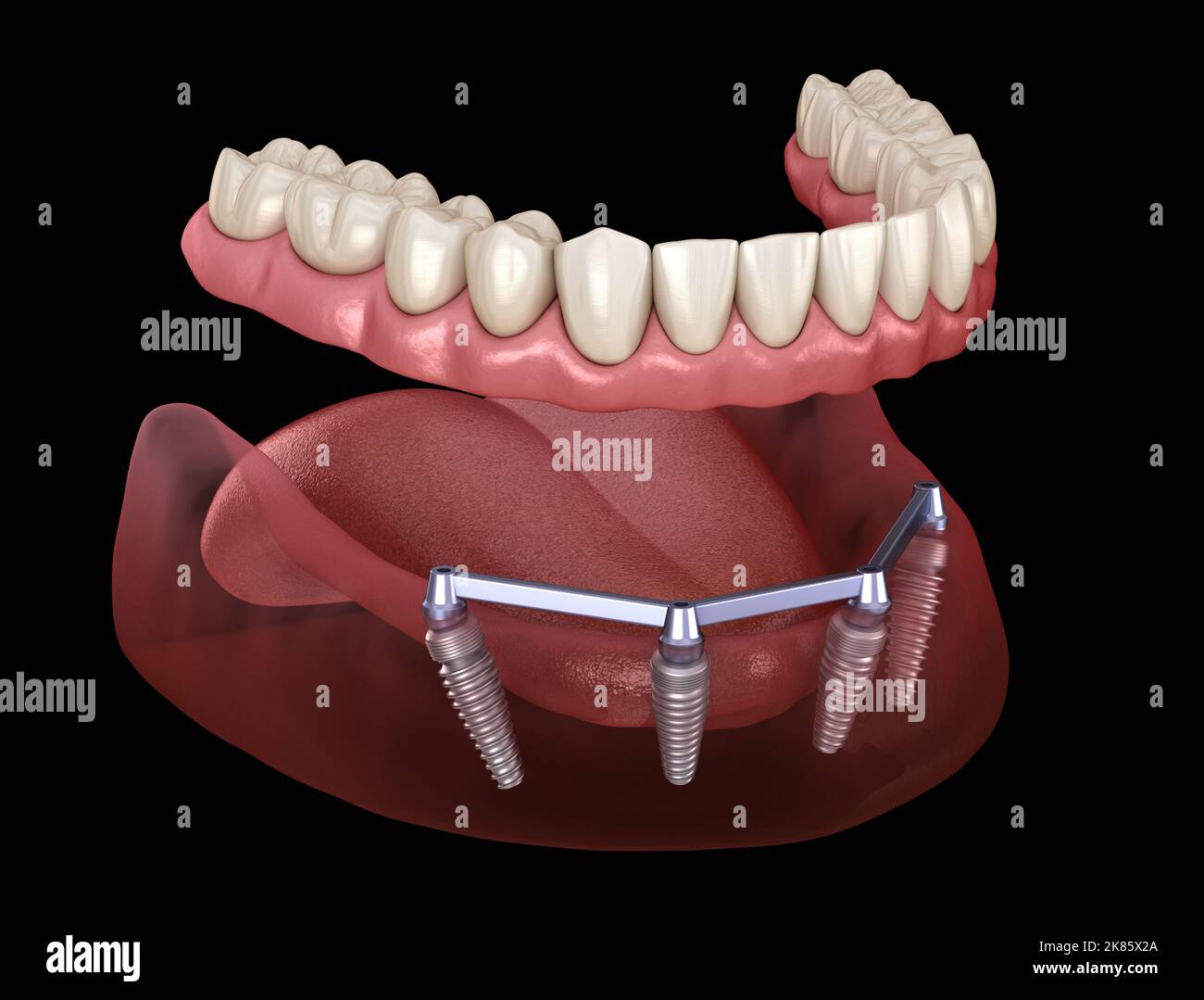 Removable Mandibular prosthesis with gum All on 4 system supported by ...