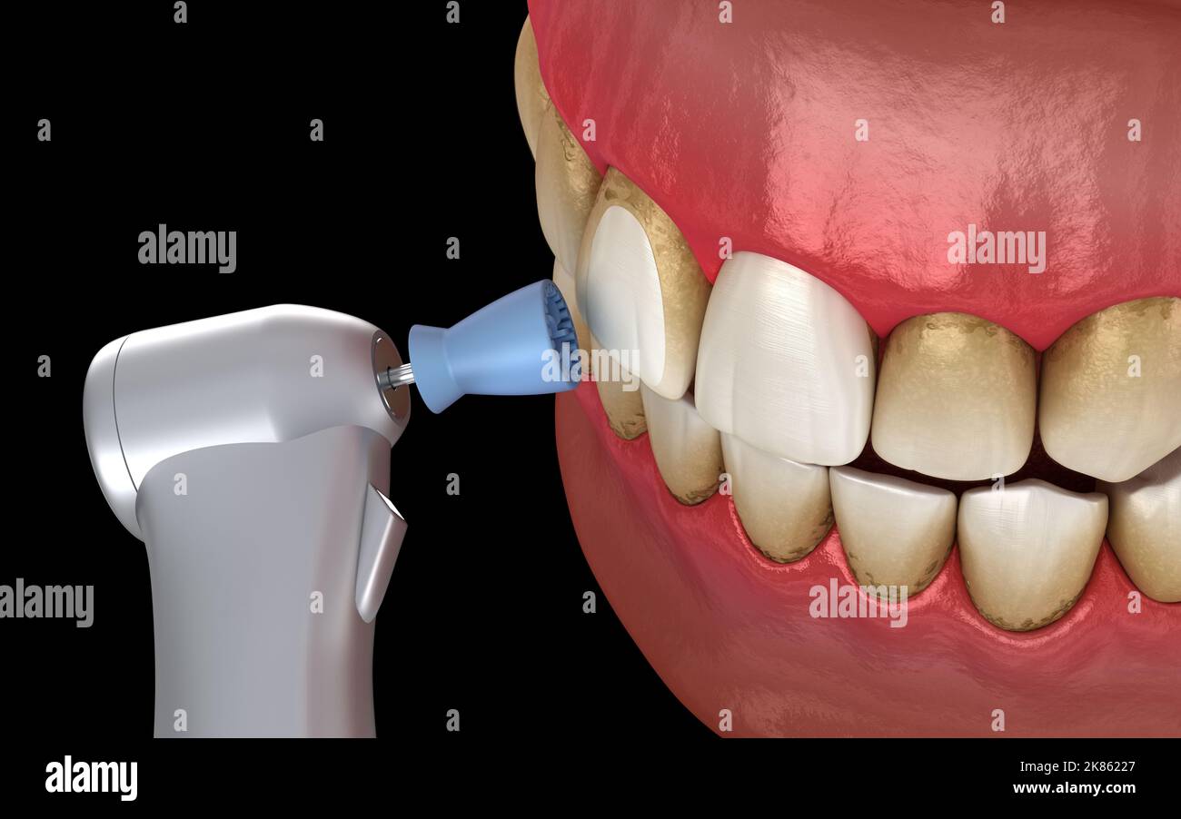 Teeth polishing procedure with professional brush and gel. Medically ...