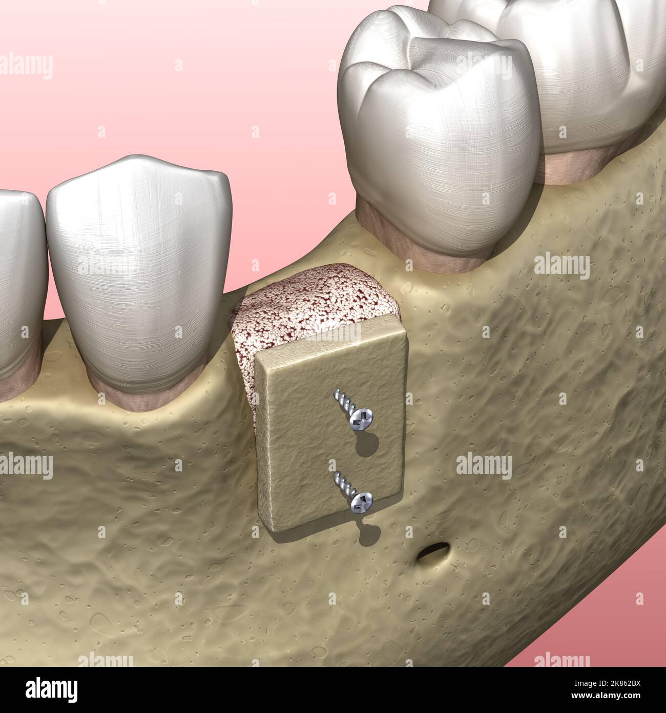 Augmentation Surgery - Bone transplantation, preparing for implantation ...
