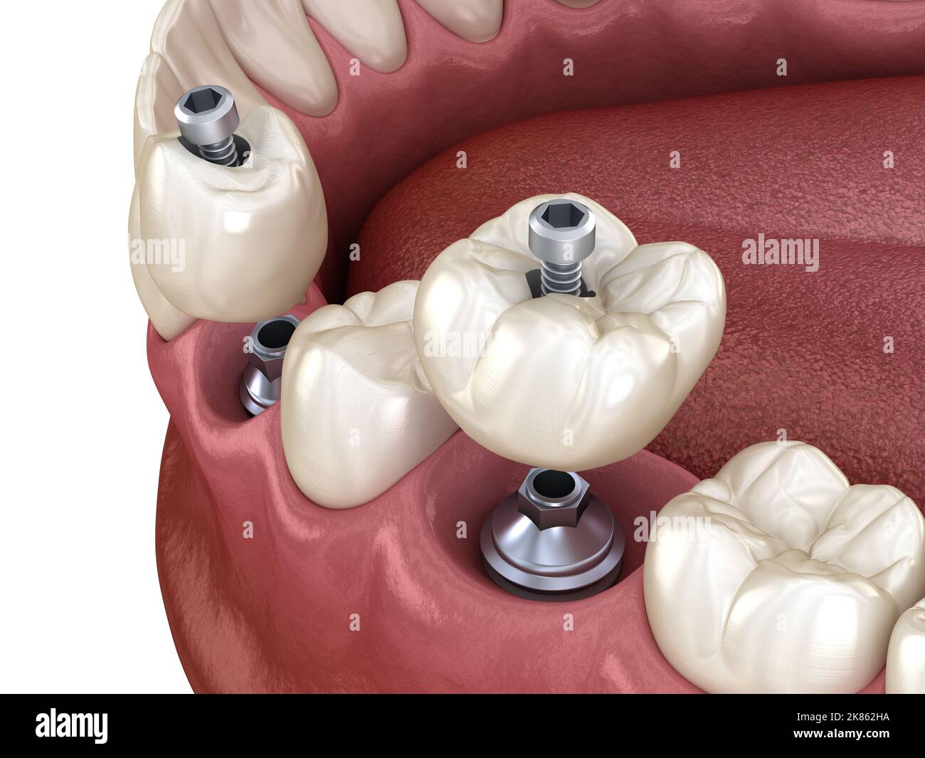 Premolar and Molar tooth crown installation over implant, screw ...