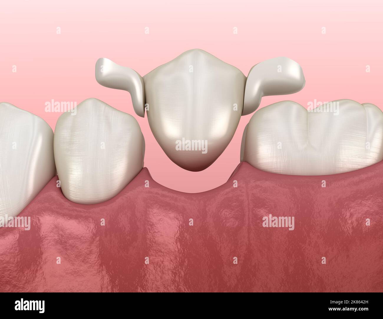 Maryland bridge made from ceramic, premolar tooth recovery. Medically ...