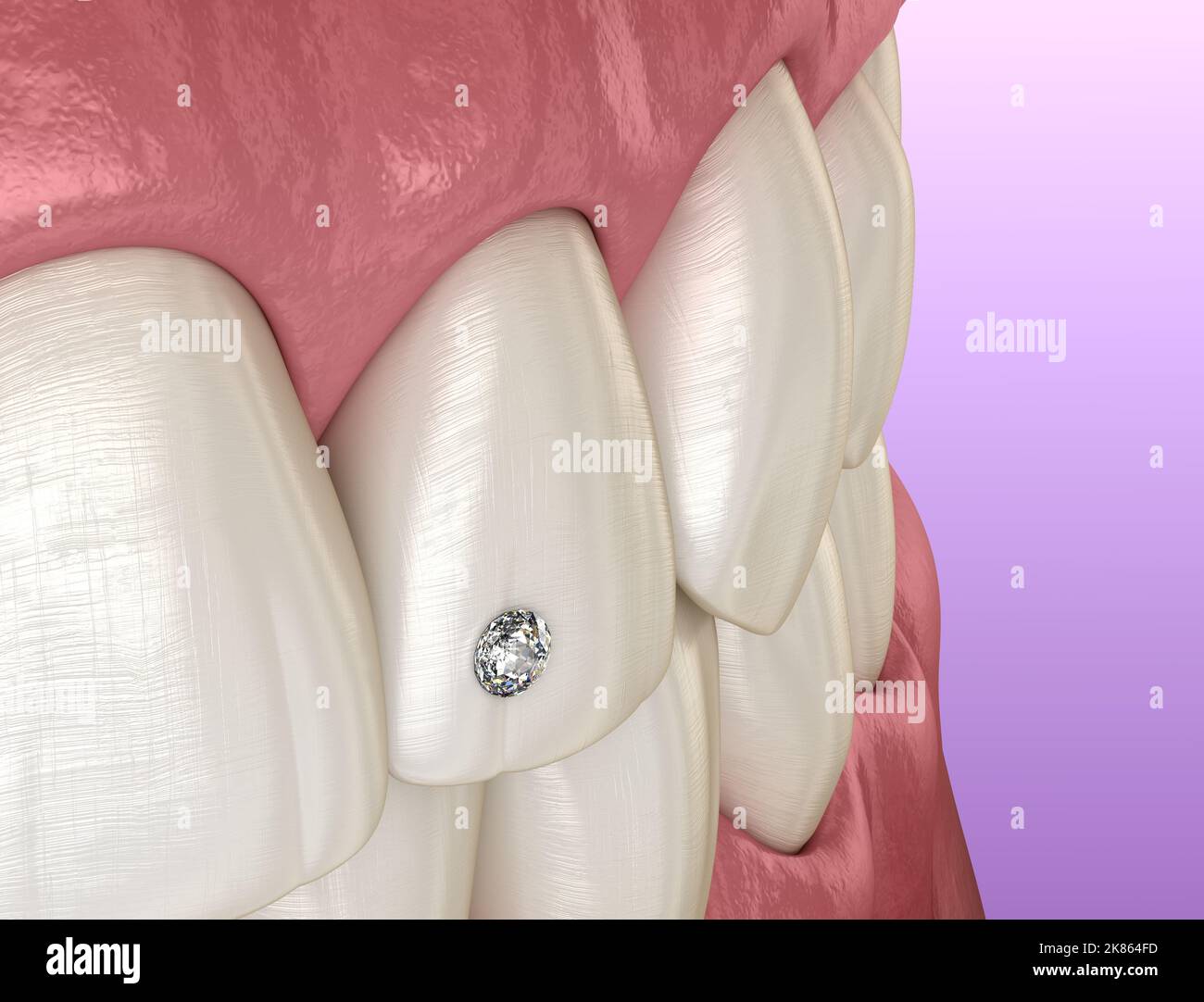Tooth piercing by diamond, 3D illustration concept Stock Photo - Alamy