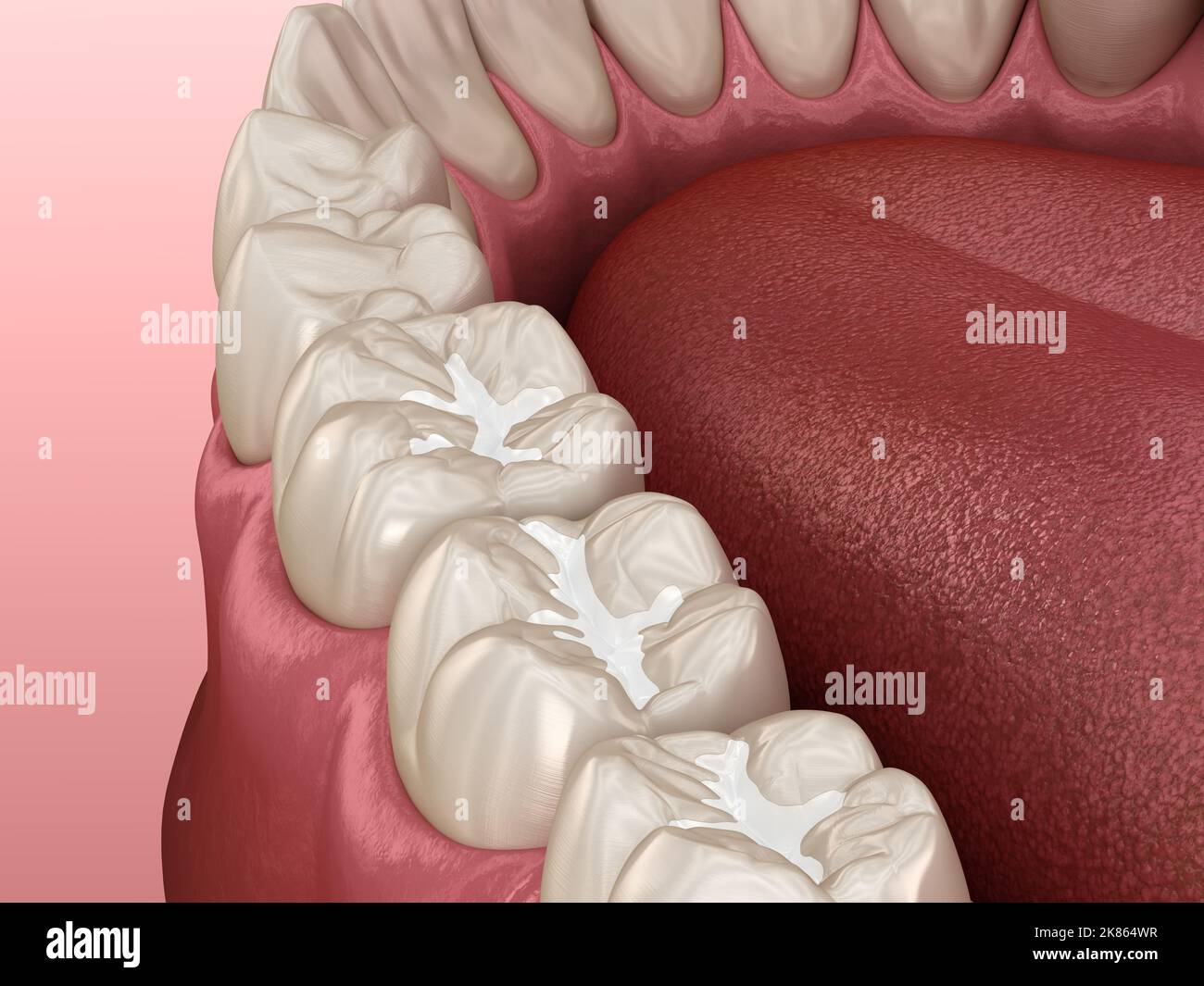 Molar Fissure dental fillings, Medically accurate 3D illustration of ...