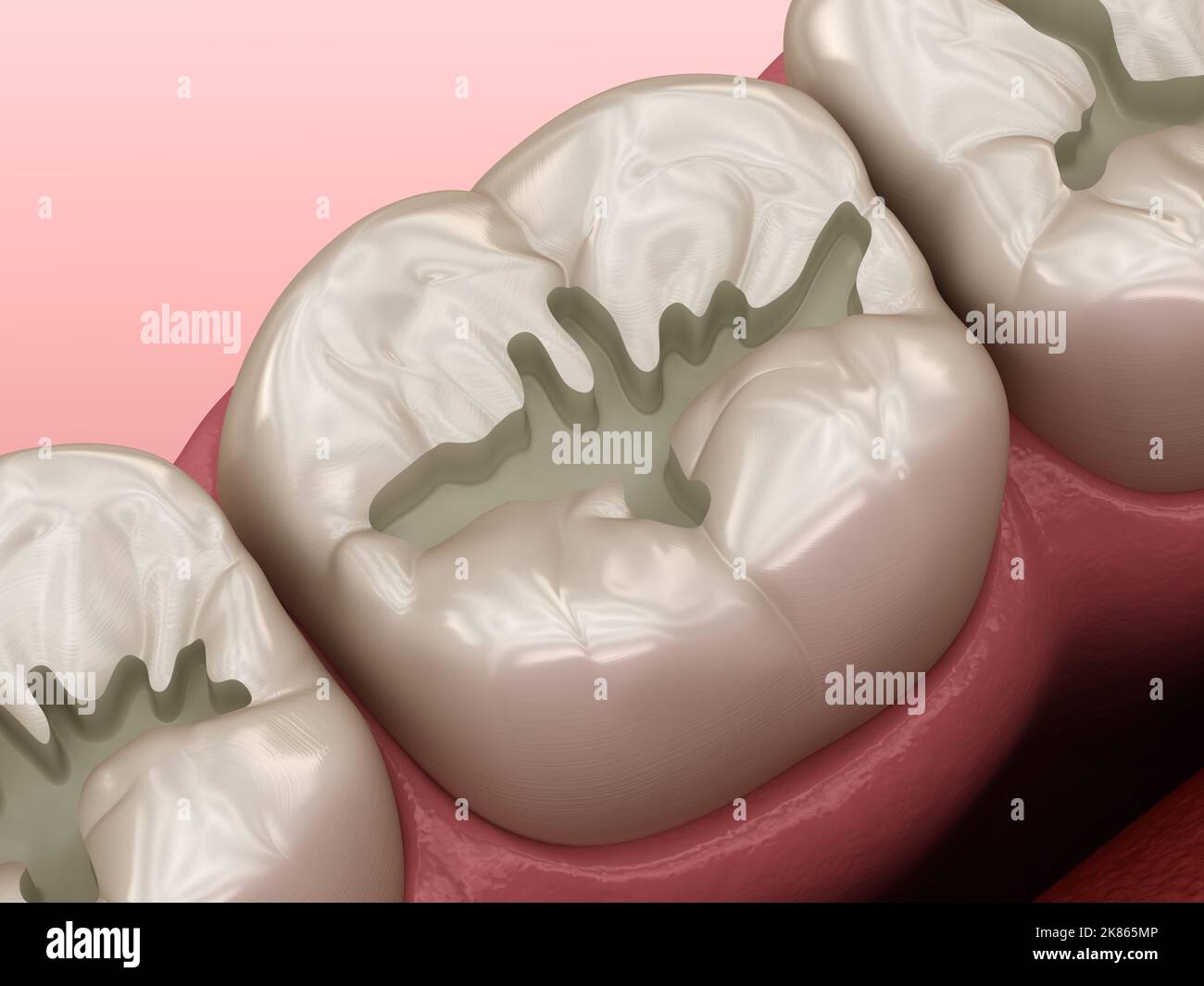 Prepareted Molar Fissure for fillings placement, Medically accurate 3D ...