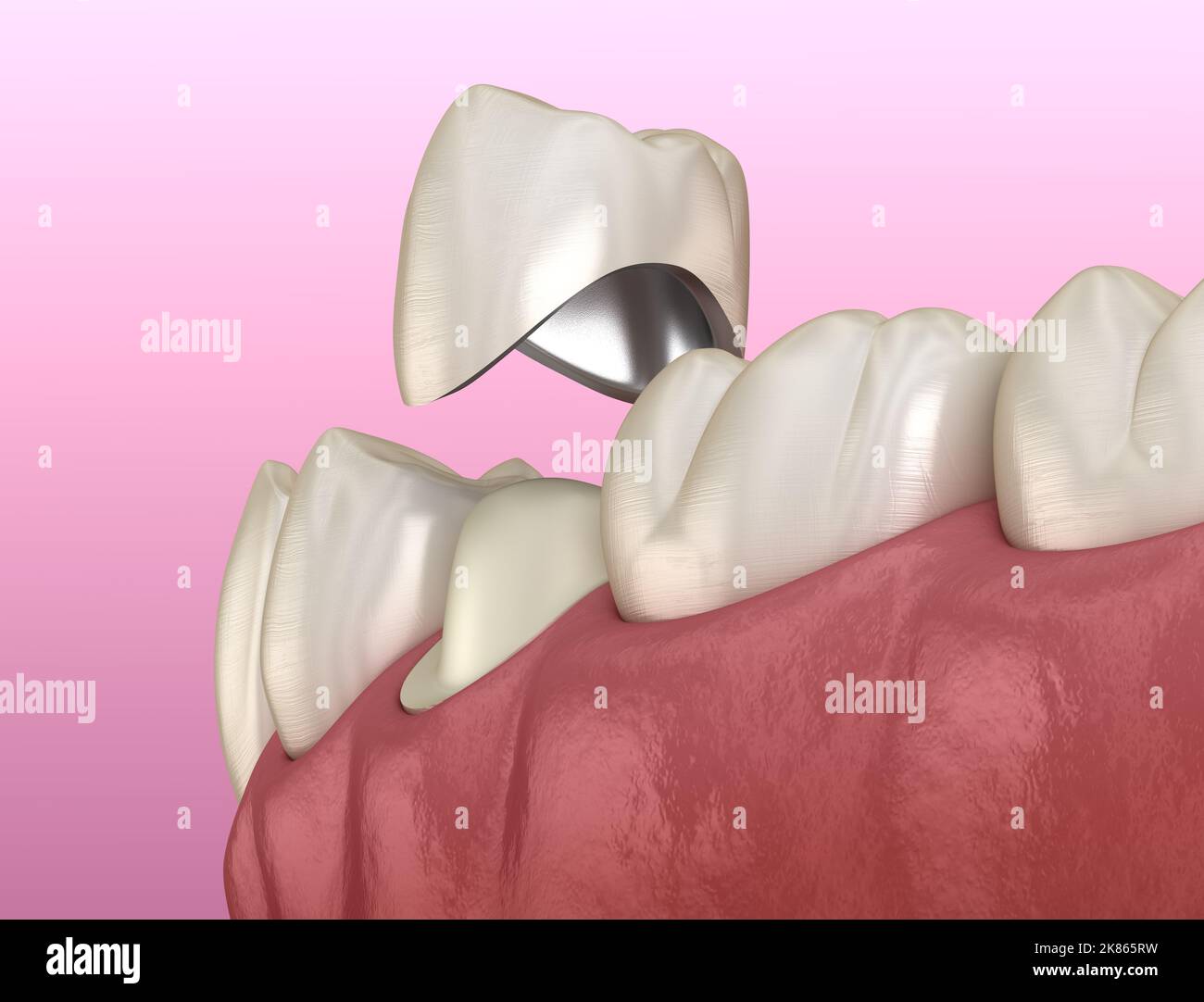 Preparation crown hi-res stock photography and images - Alamy