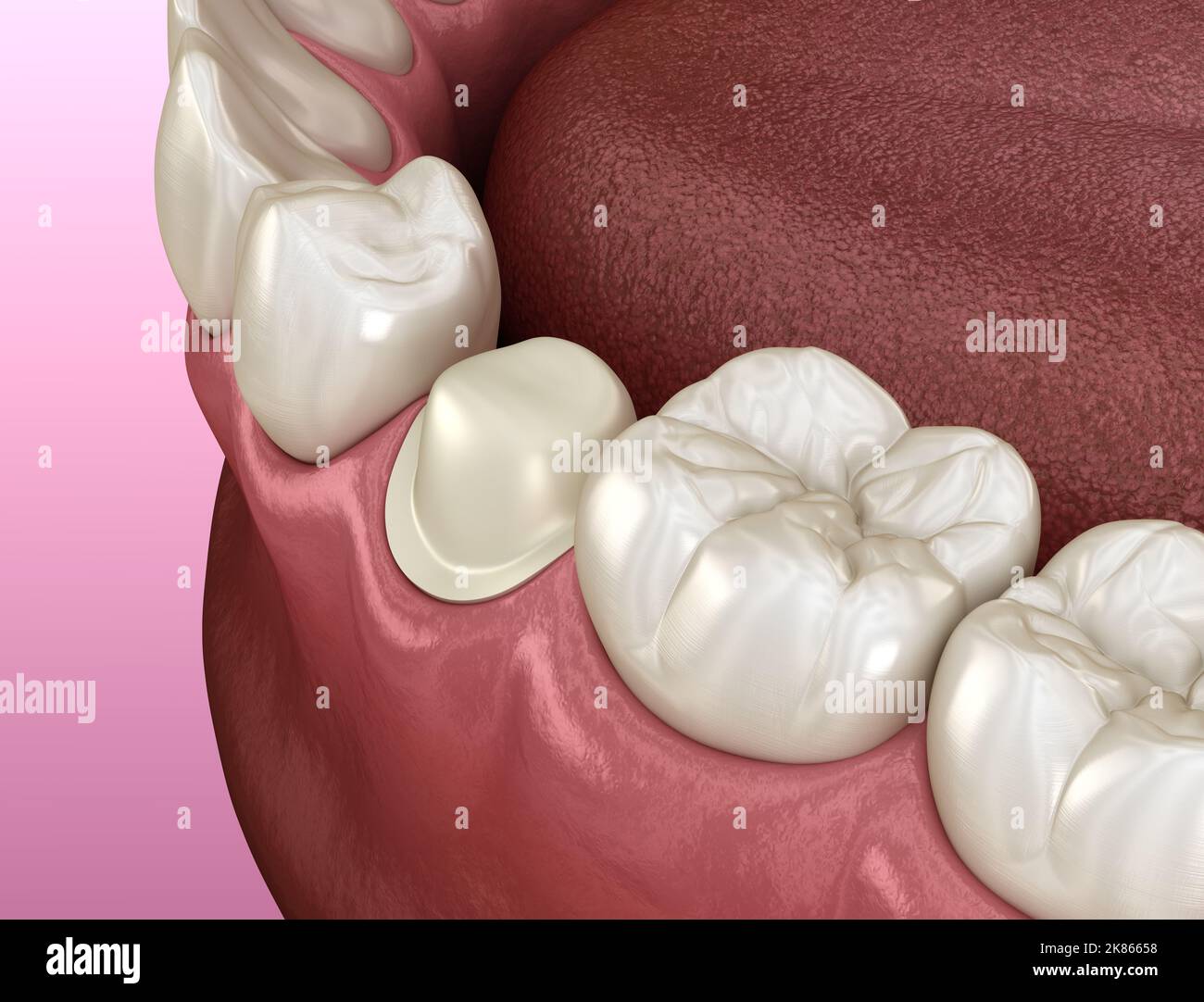 Preparated premolar tooth for dental metal-ceramic crown placement ...