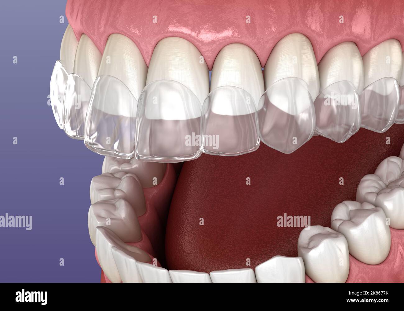 Invisalign braces or invisible retainer. Medically accurate dental 3D ...