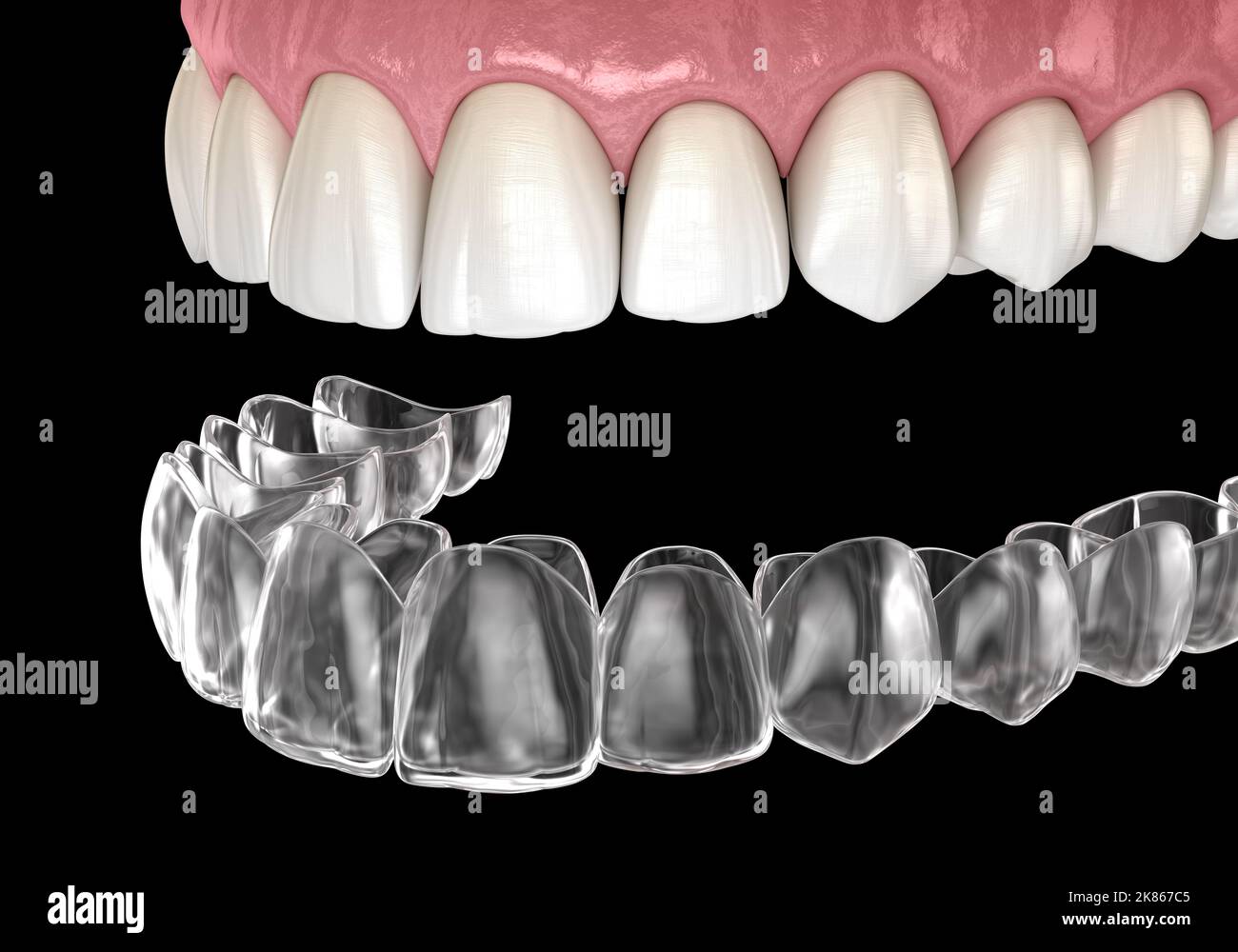 Invisalign braces or invisible retainer. Medically accurate dental 3D ...
