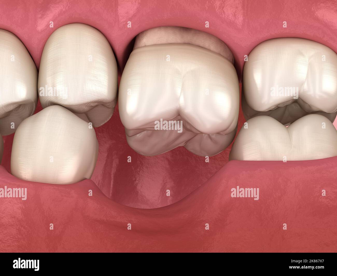 Teeth shift deformatiuon after losing molar tooth. 3D illustration of ...