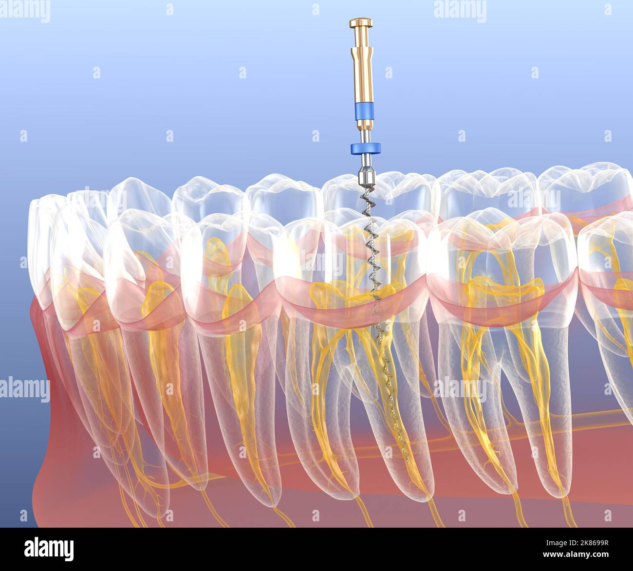 Endodontic root canal treatment process. Medically accurate tooth 3D ...