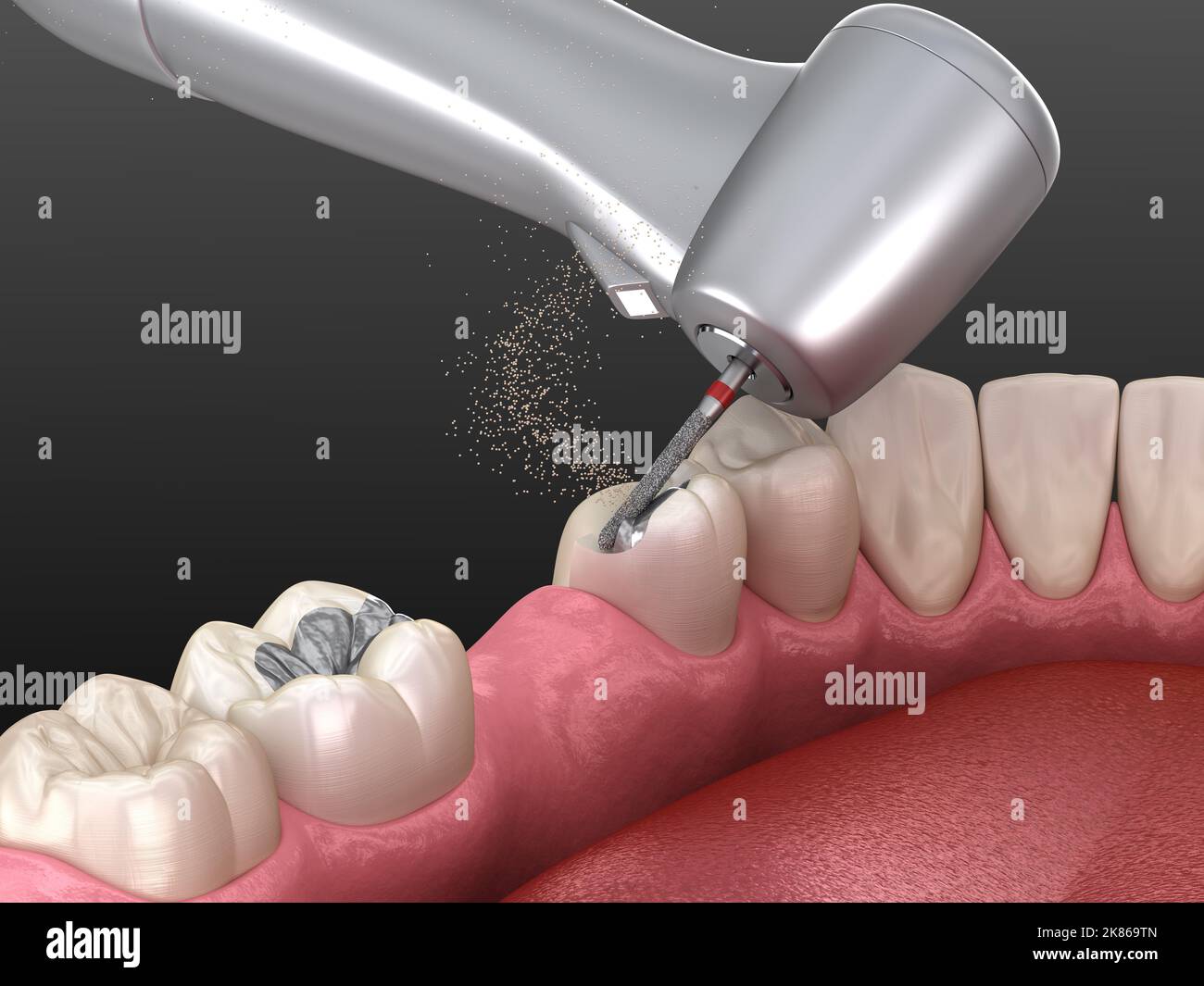Amalgam removing and preparation for ceramic crown placement. 3D ...