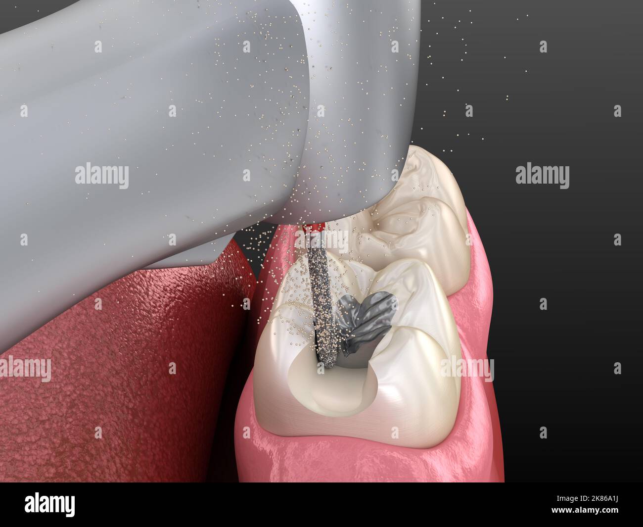 Amalgam removing and preparation for ceramic crown placement. 3D ...