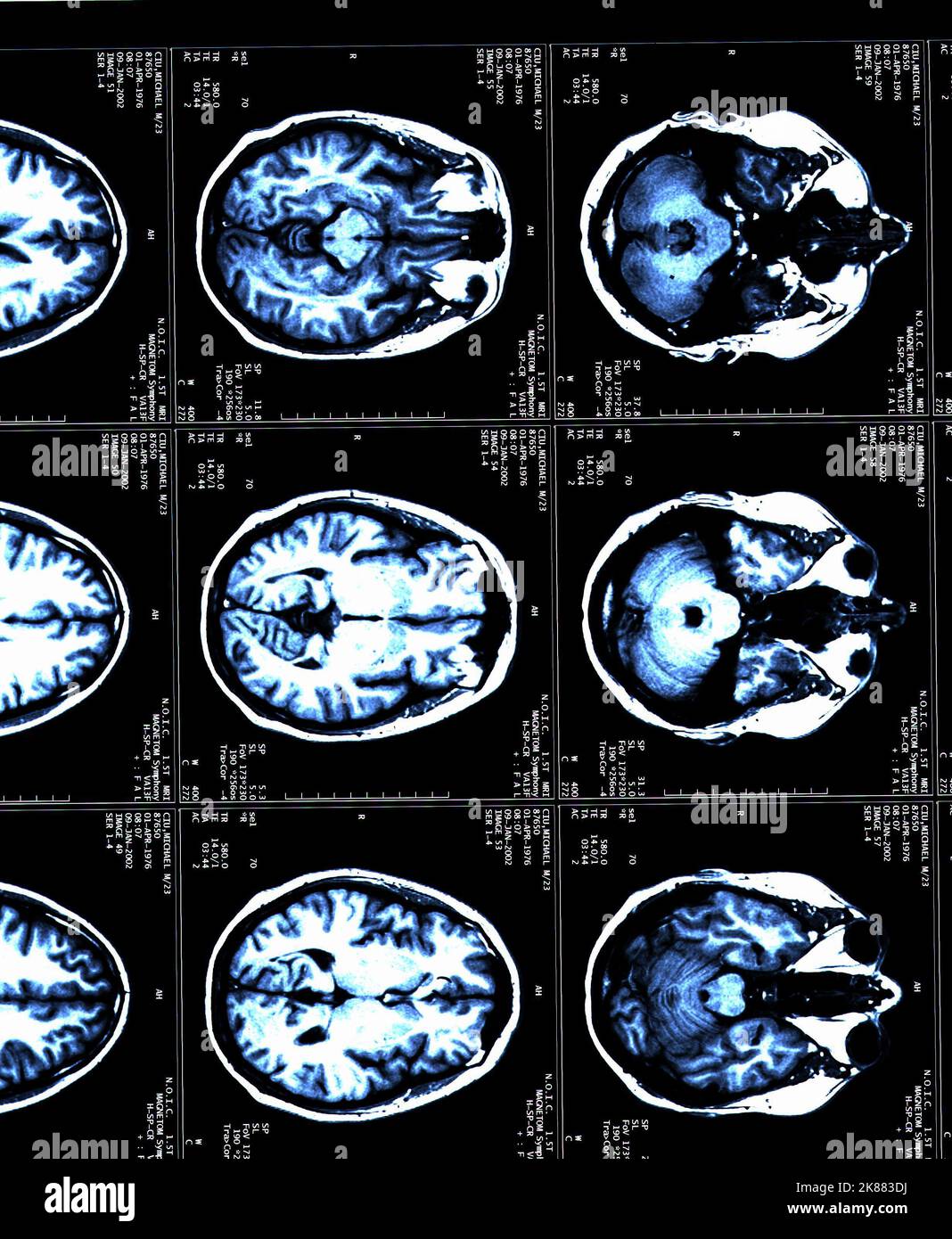 A MRI brain scans of a patient with Multiple Sclerosis Stock Photo - Alamy