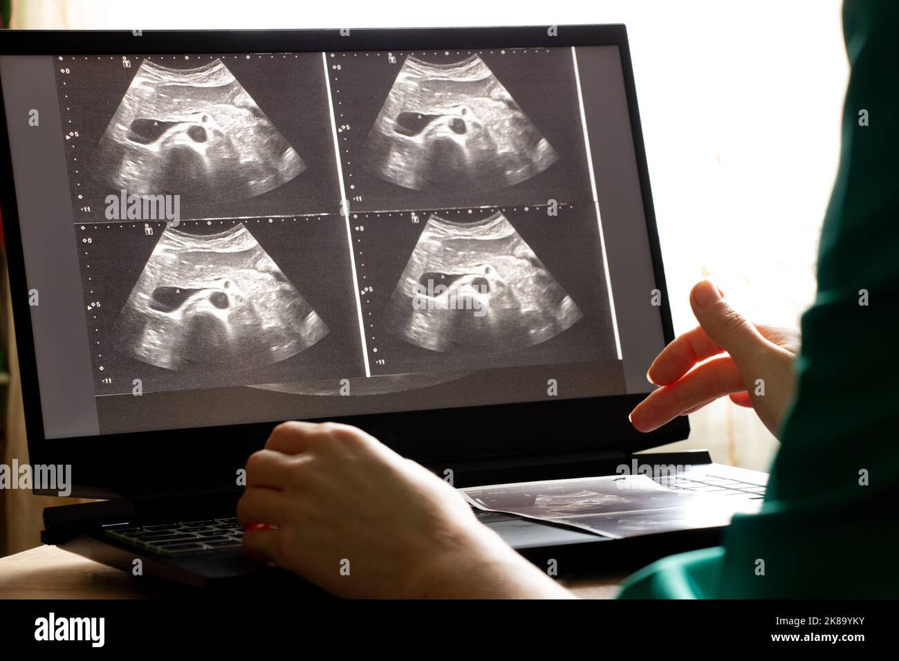 Ultrasound of a woman's abdomen on a laptop screen monitor in a doctor ...