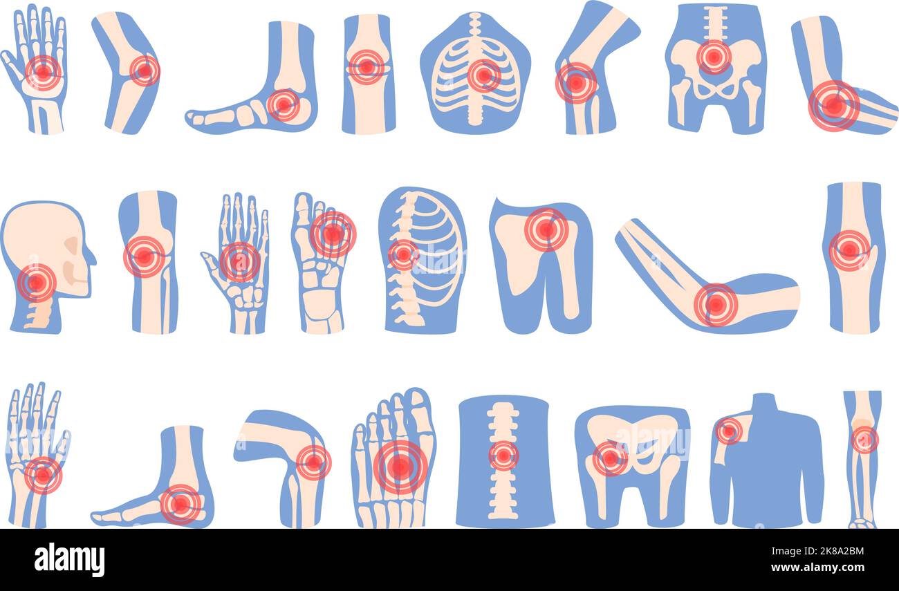 Arthritis icons set cartoon vector. Joint injury. Medical science Stock ...