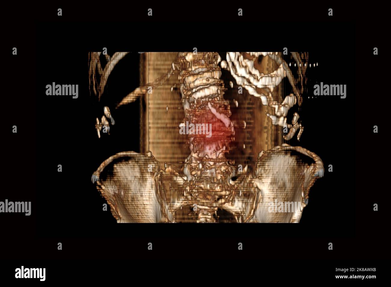 computed tomography of the spine with a fracture of the vertebrae and ...