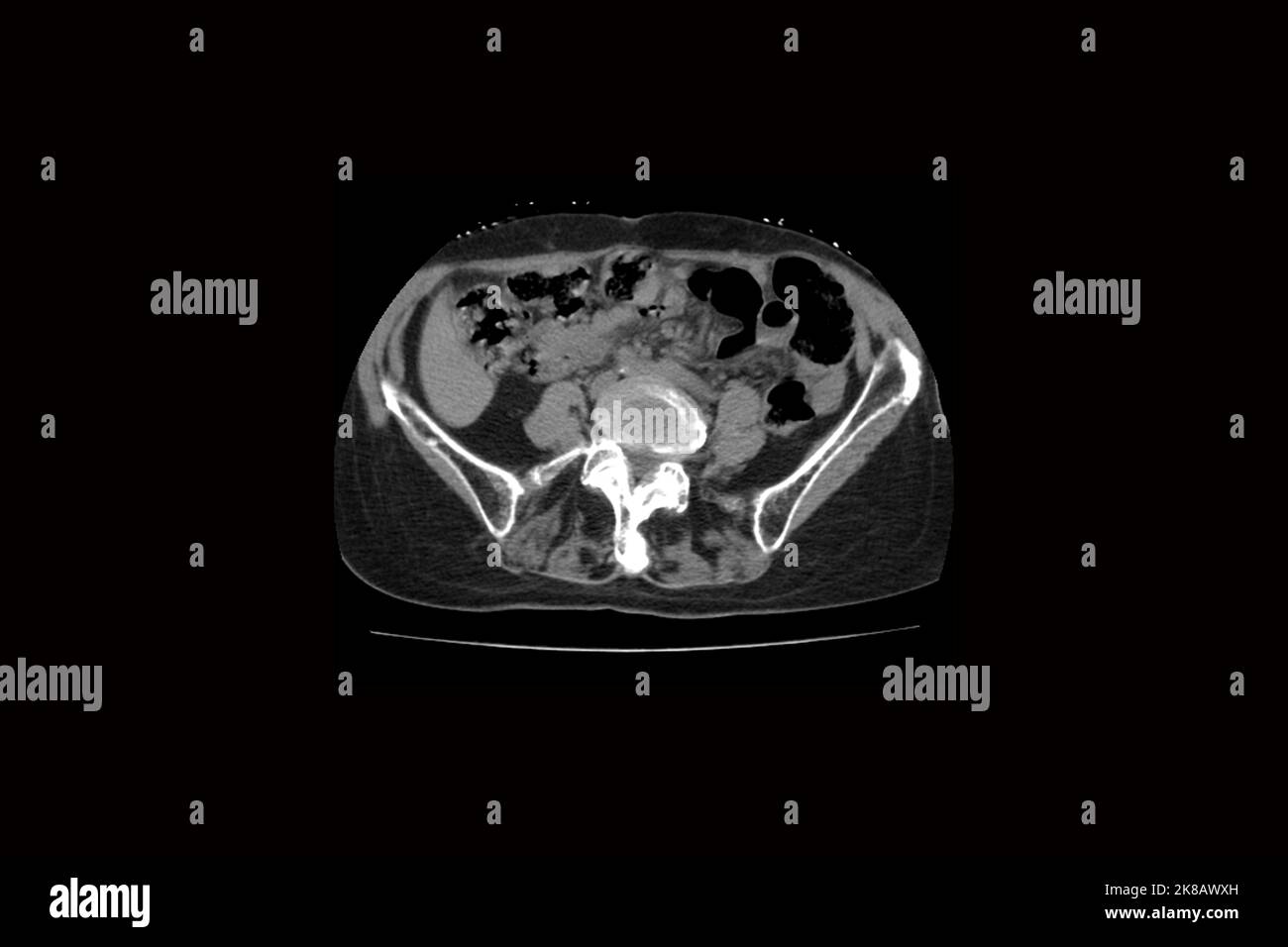computed tomography of the spine with a fracture of the vertebrae and ...