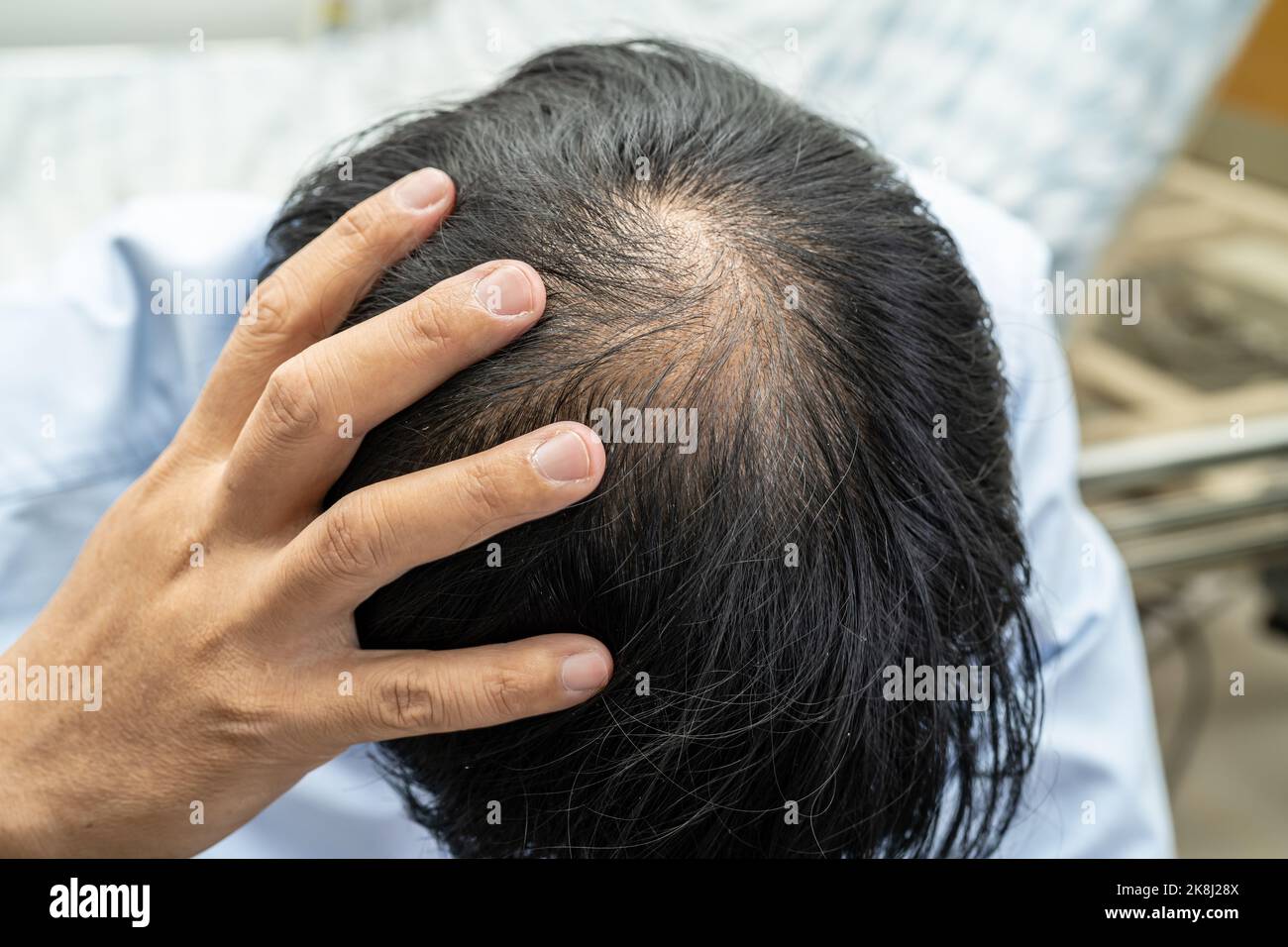 Bald in the middle head and begin no loss hair glabrous of mature Asian ...