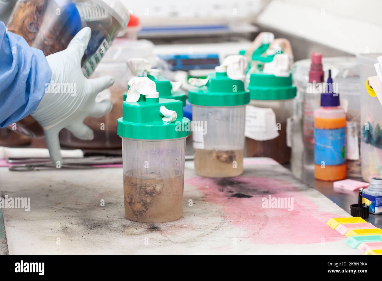 Biopsy samples being processed at the pathology laboratory to be ...