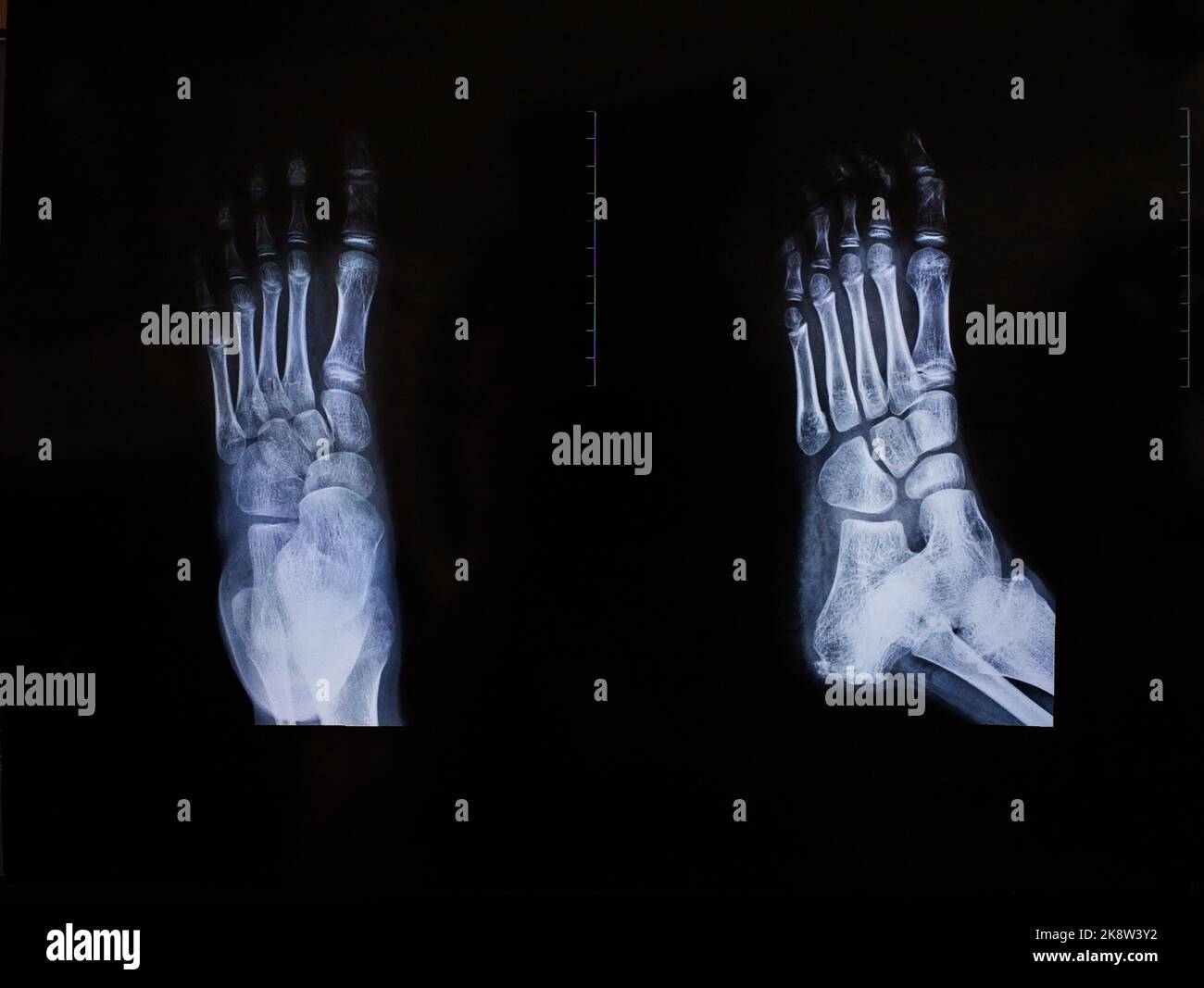 X-ray of the foot in two projections Stock Photo - Alamy