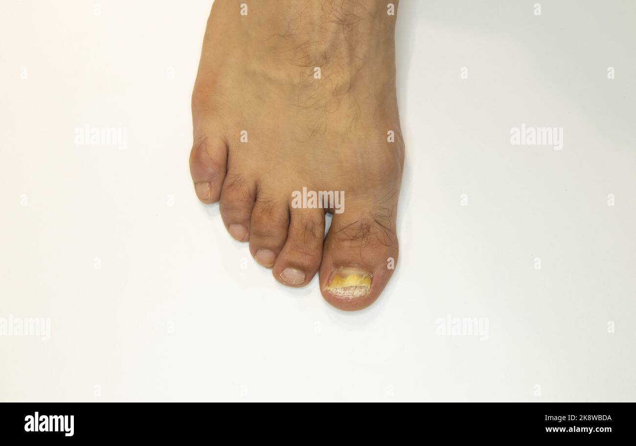 unhealthy toes with toenails affected by fungal disease Stock Photo - Alamy