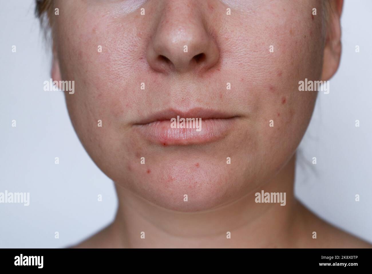 Acne scars hi-res stock photography and images - Alamy