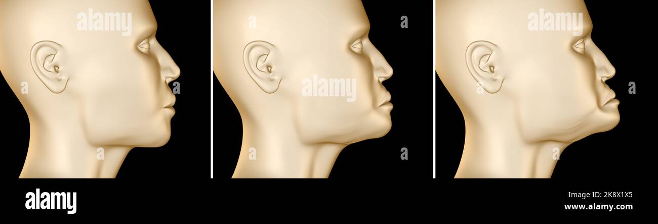 Mandibular Jaw, bone recession after losing teeth. Medically accurate ...