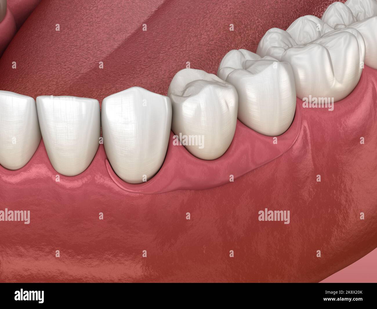 Partial removable immediate-denture type Butterfly. Replacement of one ...