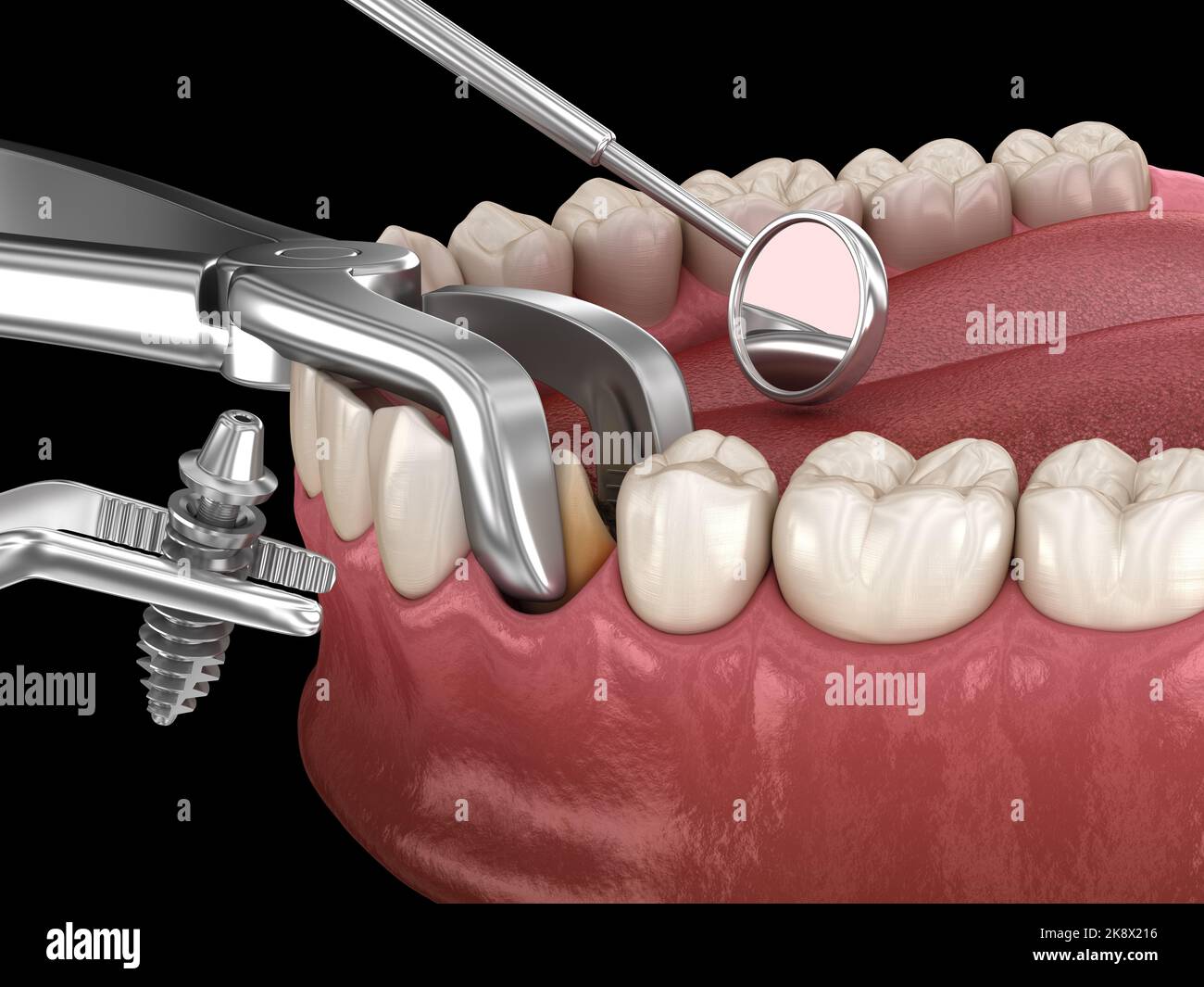 Extraction and Implantation, complex immediate surgery. Medically ...