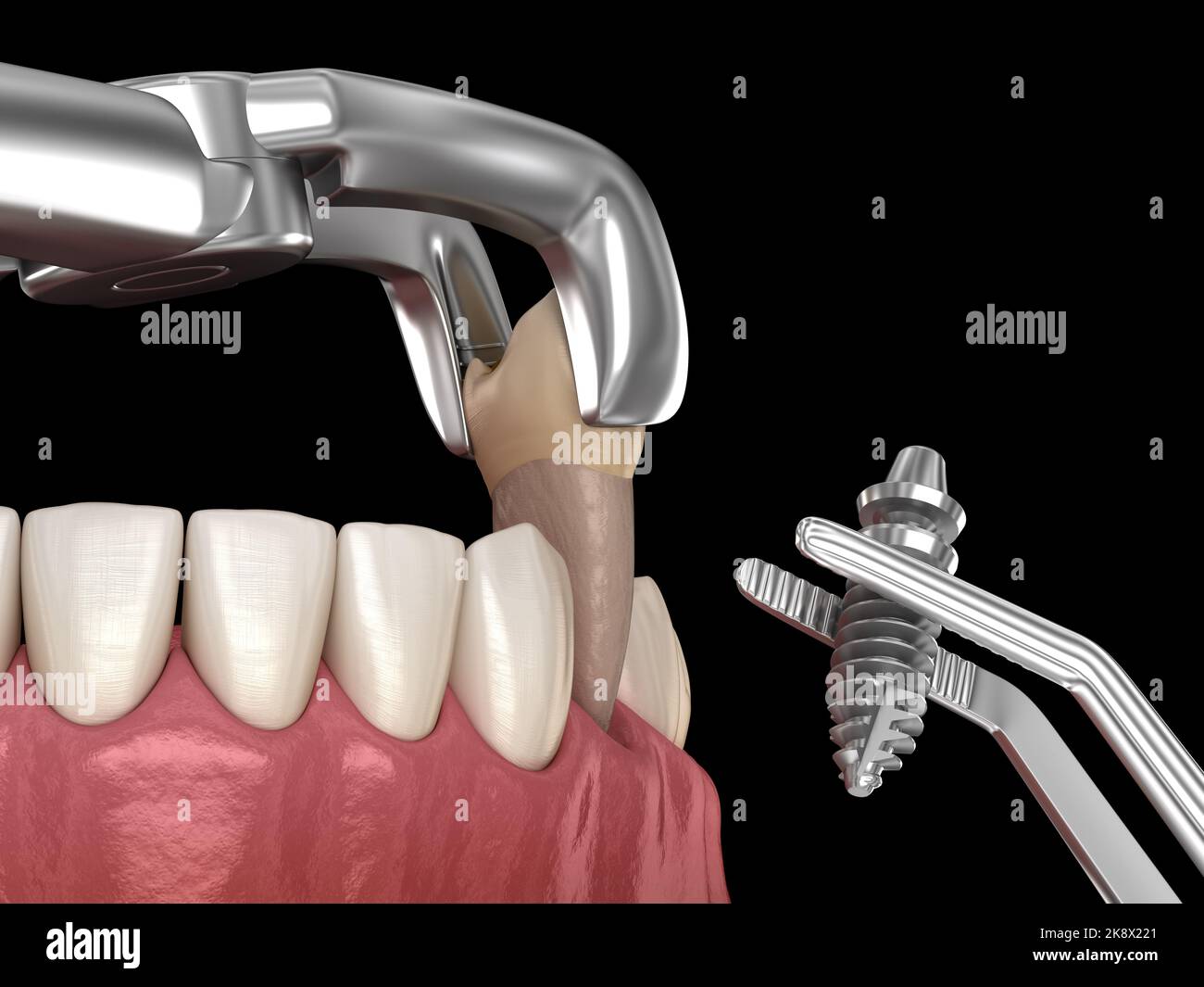 Extraction and Implantation, complex immediate surgery. Medically ...