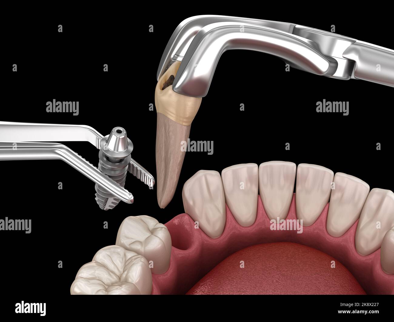Extraction and Implantation, complex immediate surgery. Medically ...