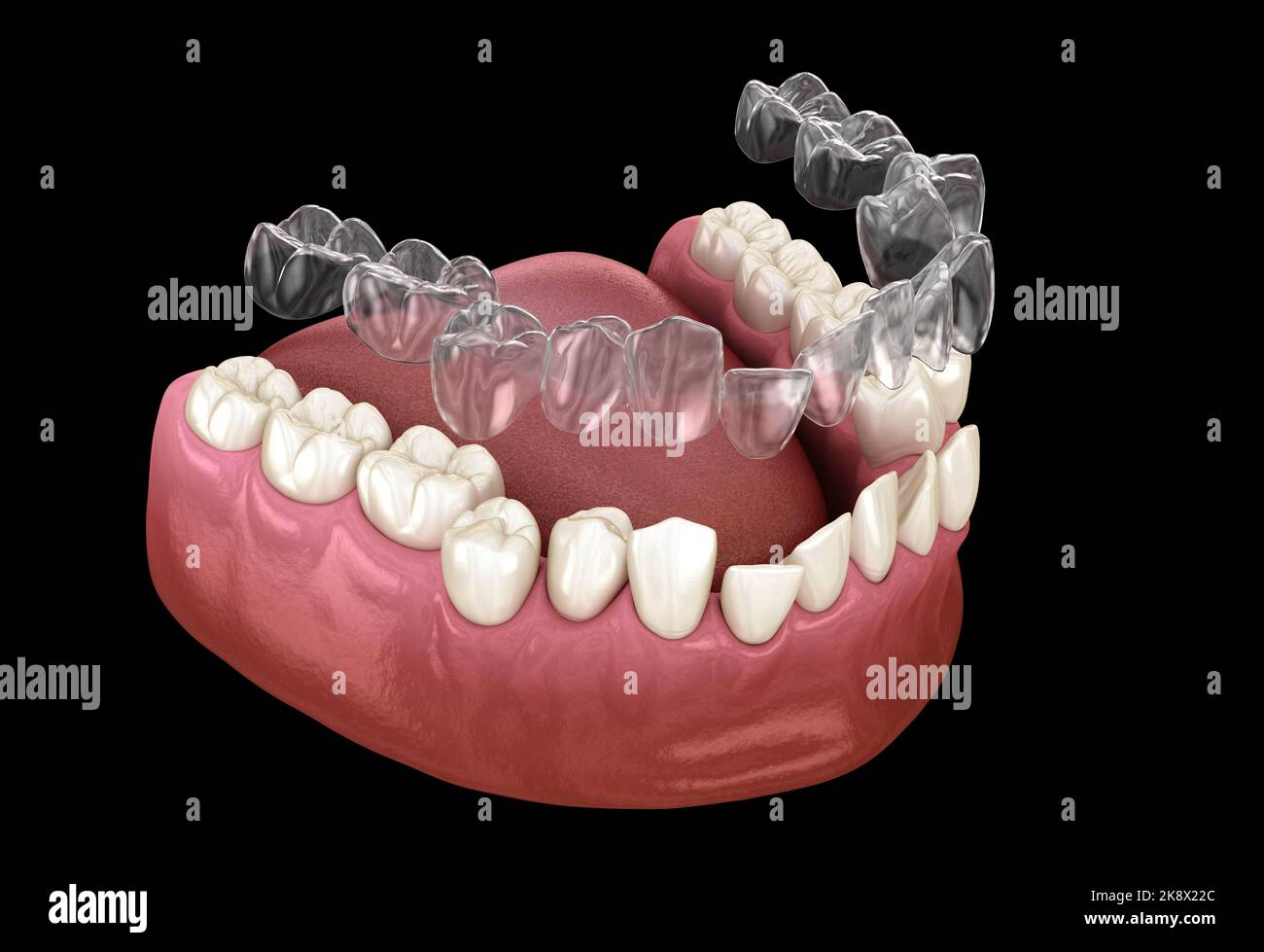 Invisalign braces or invisible retainer make bite correction. Medically ...