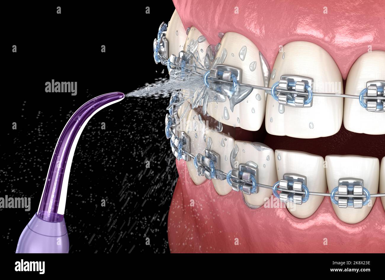 Irrigator cleaning braces with water jet. Medically accurate 3D ...