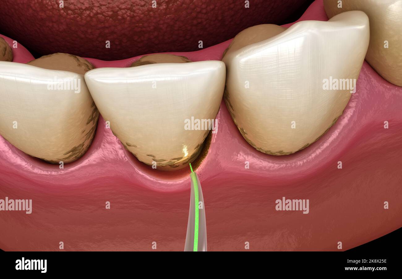 Laser removes a thin layer of infected skin, teeth cleaning. Medically ...